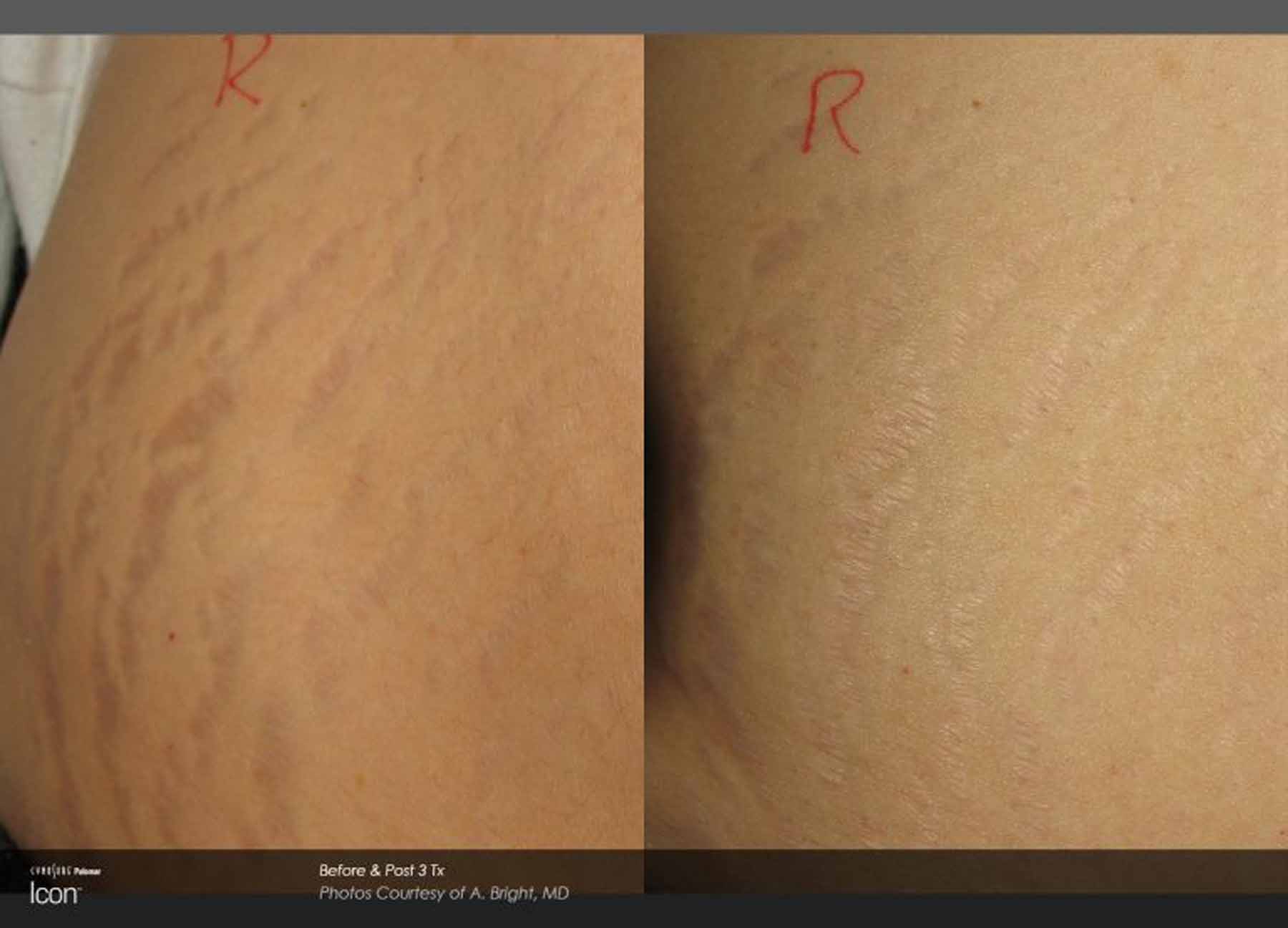 Stretch Mark Removal Treatments - Lindon UT