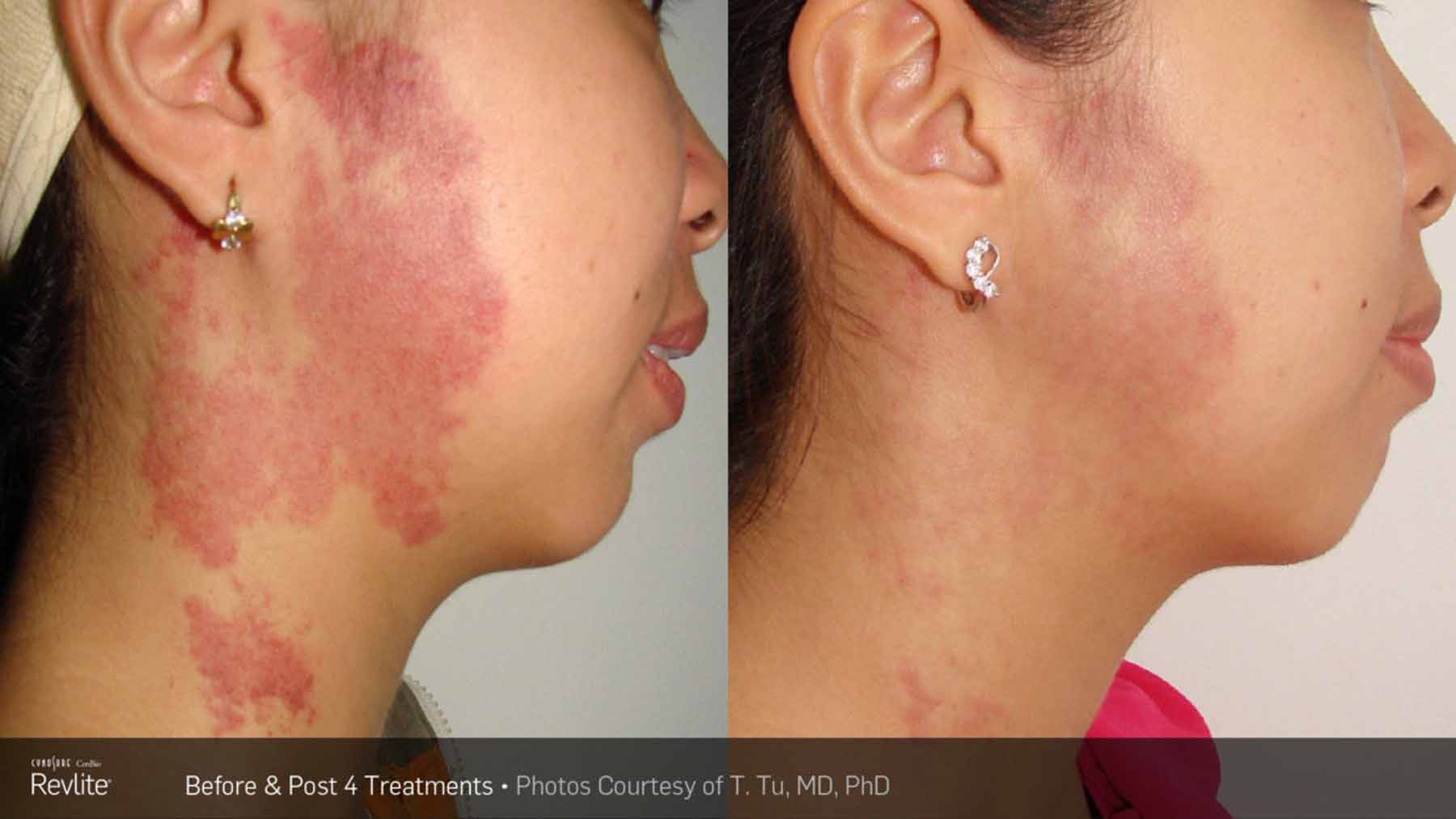 RevLite Q-Switched Laser - Lindon UT