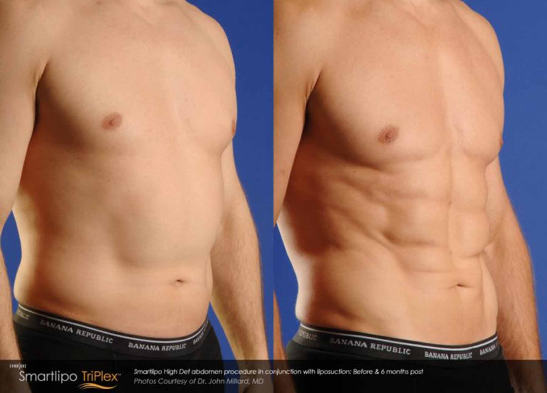 SmartLipo Laser Lipolysis - Lindon UT